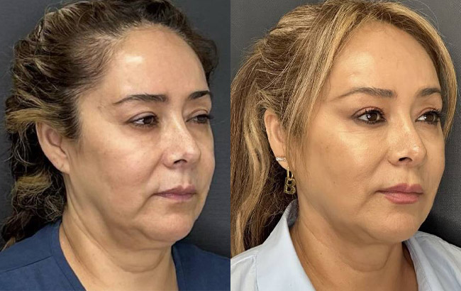 MyEllevate Neck Lift Nashville, TN | BEYOND Collective